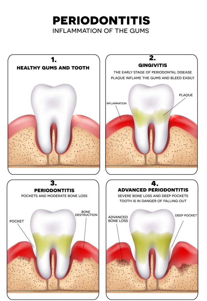 periodontal – Pottsville Beach Dental
